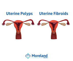 Fibroids vs. Polyps: Overview, Symptoms and Treatments for Women